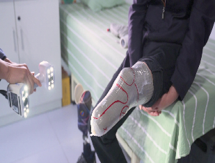 3D Prosthetic Sockets: From 3D Scan to 3D Print with Vytruve