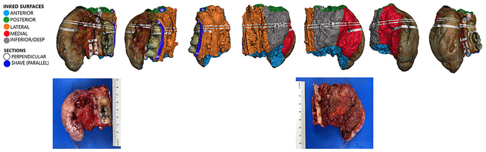 Improving Surgeons and Pathologists: 3D Scanning and Specimen Mapping
