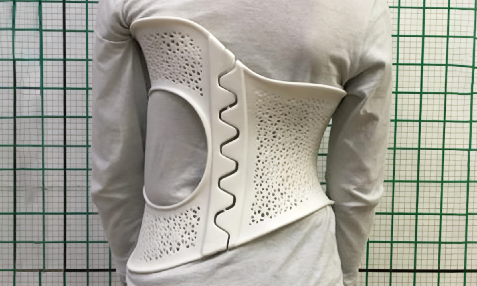 3D Scanning Application for Orthotics and Prosthetics丨SHINING 3D